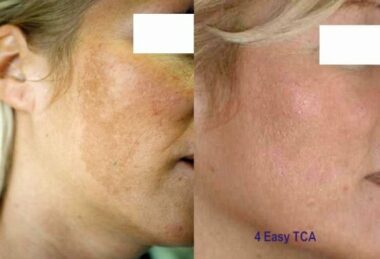 5 steps to combat hyperpigmentation