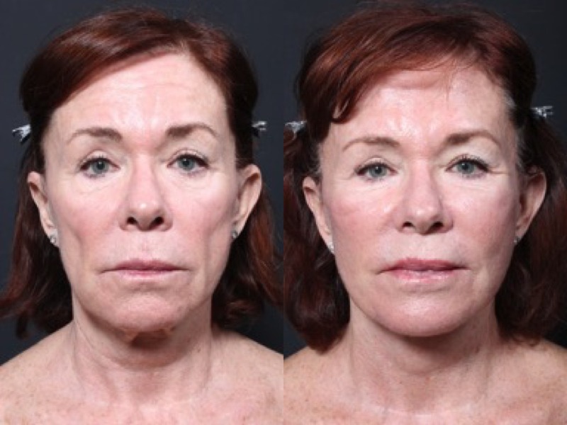 Ask the Plastic Surgeon, Dr. Repta: Non-surgical Rhinoplasty